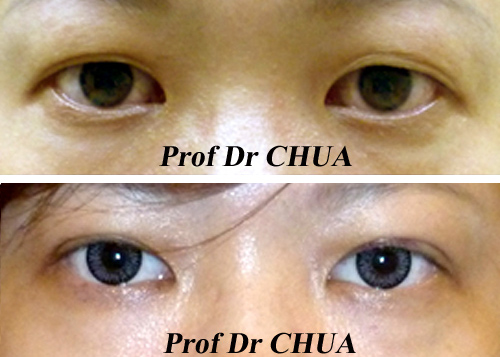 Eyelid Surgery by Prof Dr CN CHUA 蔡鐘能: One of the Many Suture ...