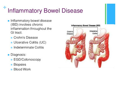 Pediatrics Notes: Diagnosing Inflammatory Bowel Disease In Children