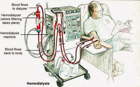Is it really possible to get off kidney dialysis?: What are your ...