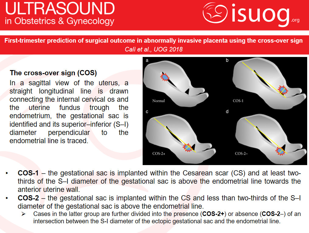 Ob/Gyn Updated : Novel cross-over sign in cesarean scar pregnancy helps ...