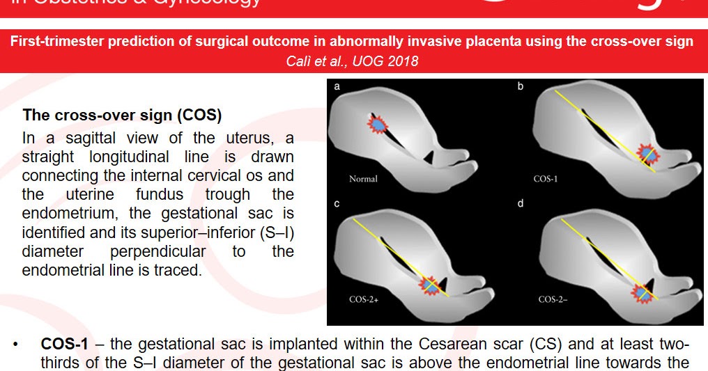 Ob/Gyn Updated : Novel cross-over sign in cesarean scar pregnancy helps ...