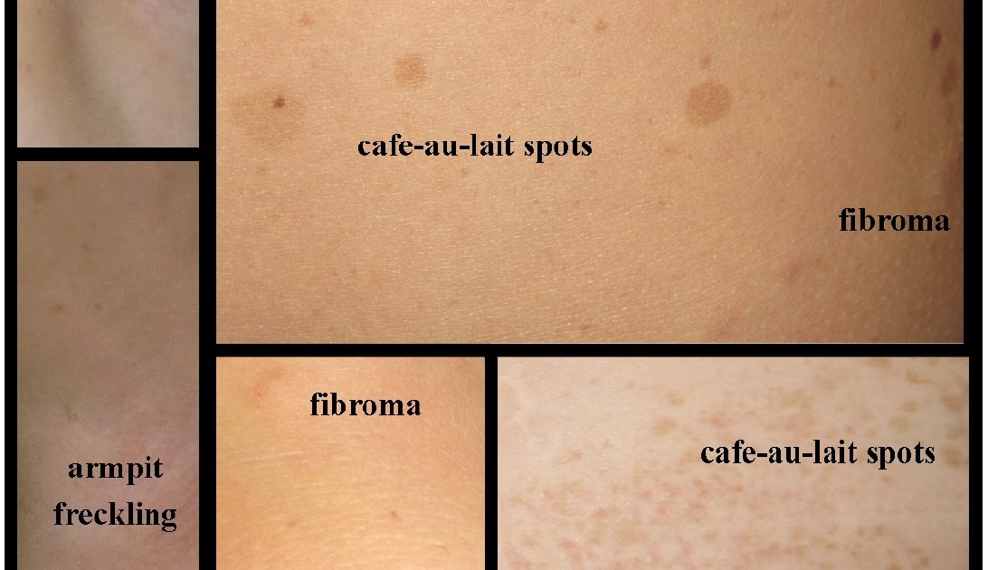 Cure NF for Kaitlyn: NF spots