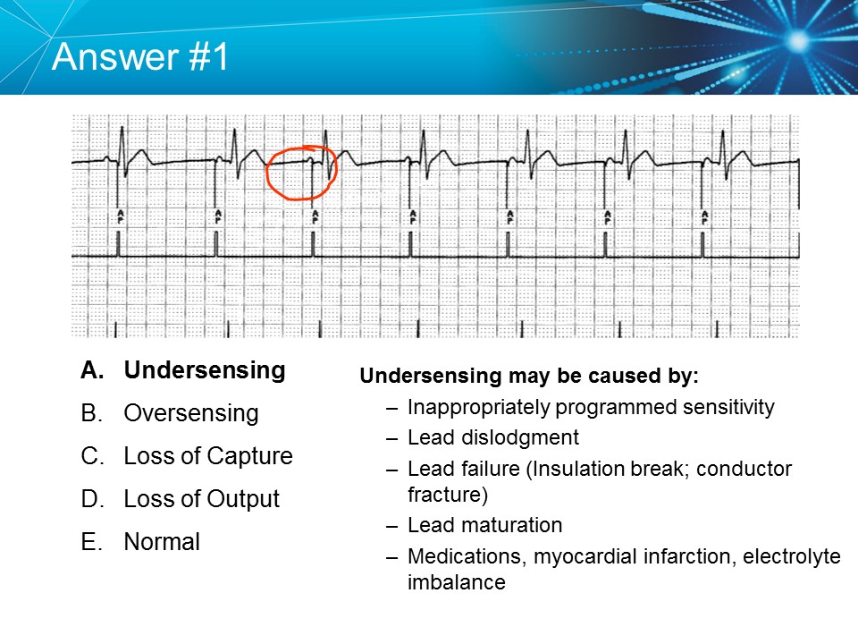 CVT Mohd Farid: Basic Pacemaker Troubleshooting Part II-Medtronic Academy