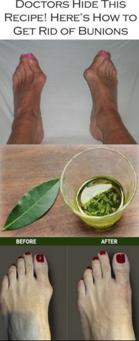 Doctors Never Tells, How to Get Rid of Bunions Completely Naturally ...