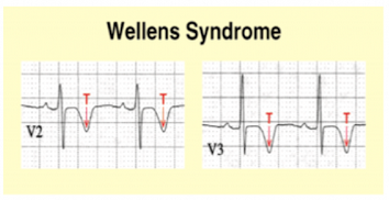 Enciclopédia de ECG - ECG de A a Z: Síndrome de Wellens