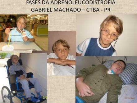 Adrenoleucodistrofia - Doença abordada no Filme - O Óleo de Lorenzo ...