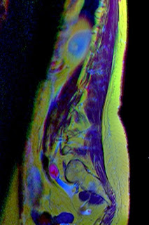 Nevit's blog: Color MRI of spine