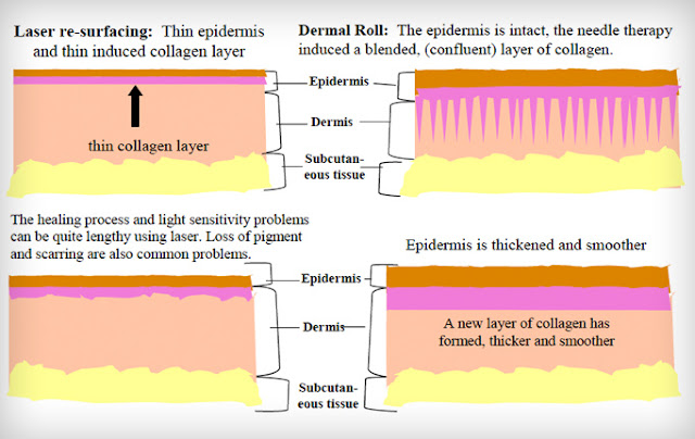 [Treatment] Depressed Acne Scars After Dermarolling (at home) | CINDITY
