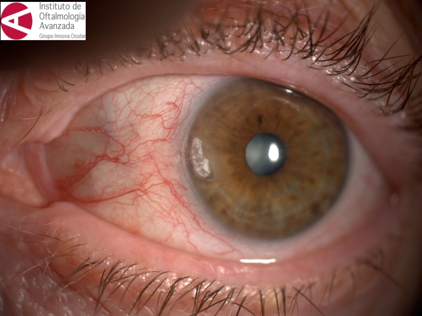 Semiología Y Salud: ANOMALÍAS DE OJO