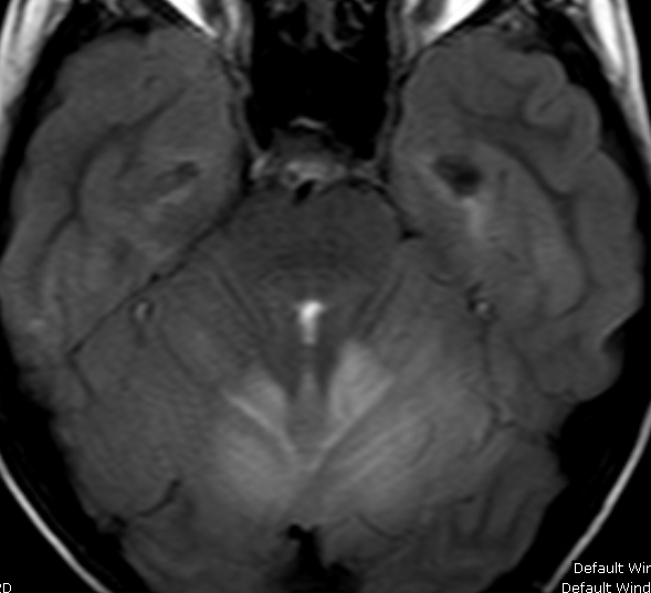 Acute Cerebellitis-is it infectious or post infectious? - Radiology Imaging