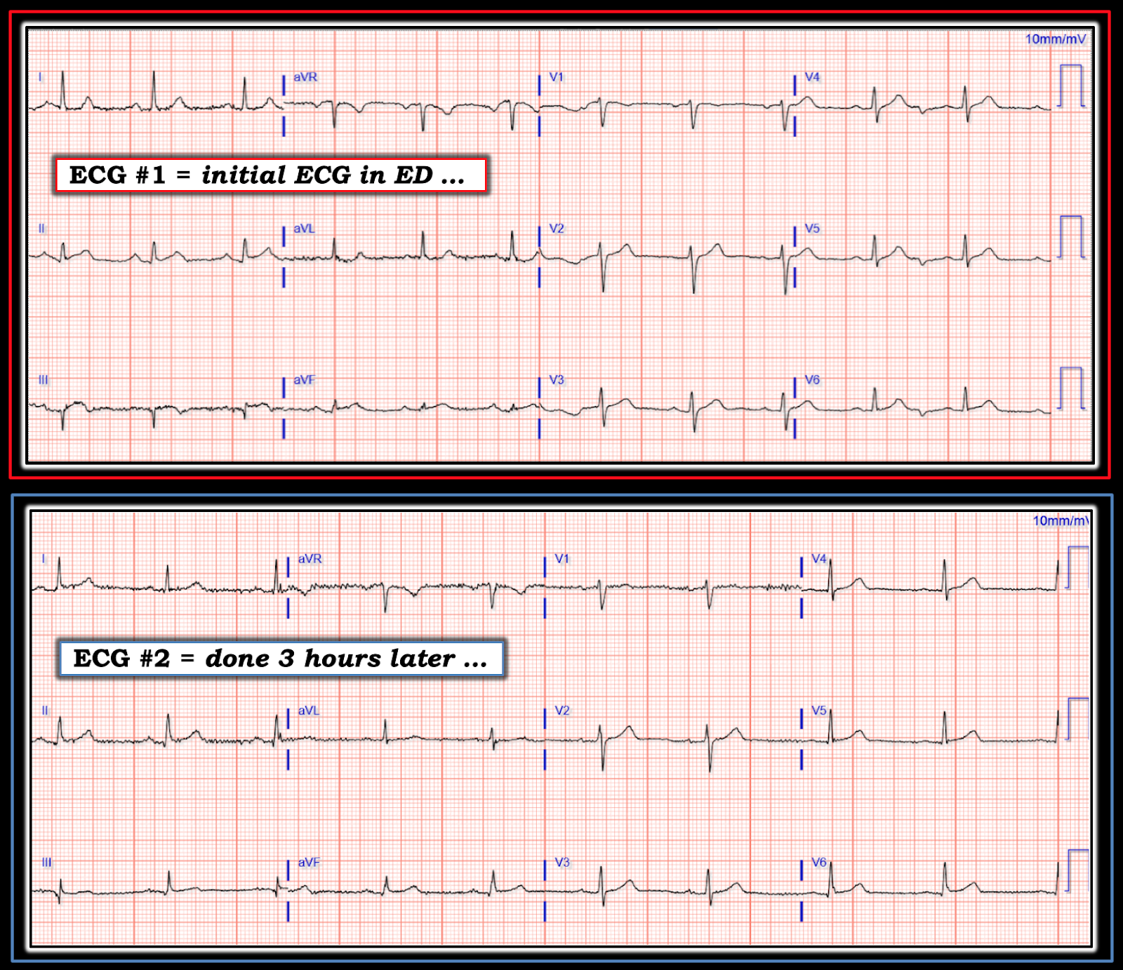 รายการ 97+ ภาพ Ekg 1 ช่องเล็ก คมชัด
