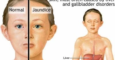 A Bank of Knowledge : Symptoms of jaundice and its types?