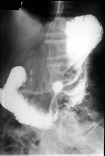 Chronic gastric Ulcer - Xray