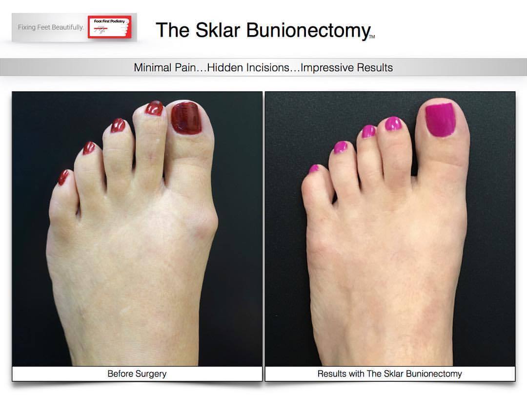 The Sklar Bunionectomy. NO casts, NO crutches and NO visible scars 💫 ...