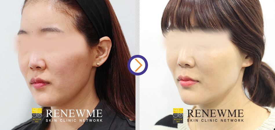 Renewme Skin Clinic Indonesia: Tanam Benang - Tarik Benang untuk ...