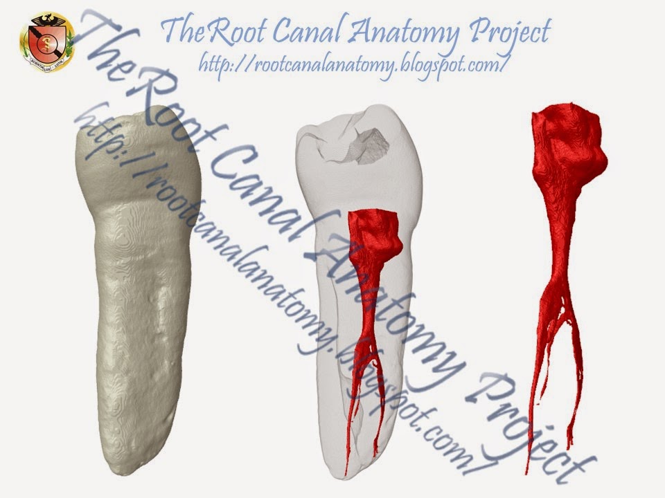 The Root Canal Anatomy Project: C-Shaped Mandibular First Premolar
