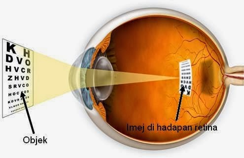 Pengertian Rabun Jauh (miopi) | Pengertian ILMU