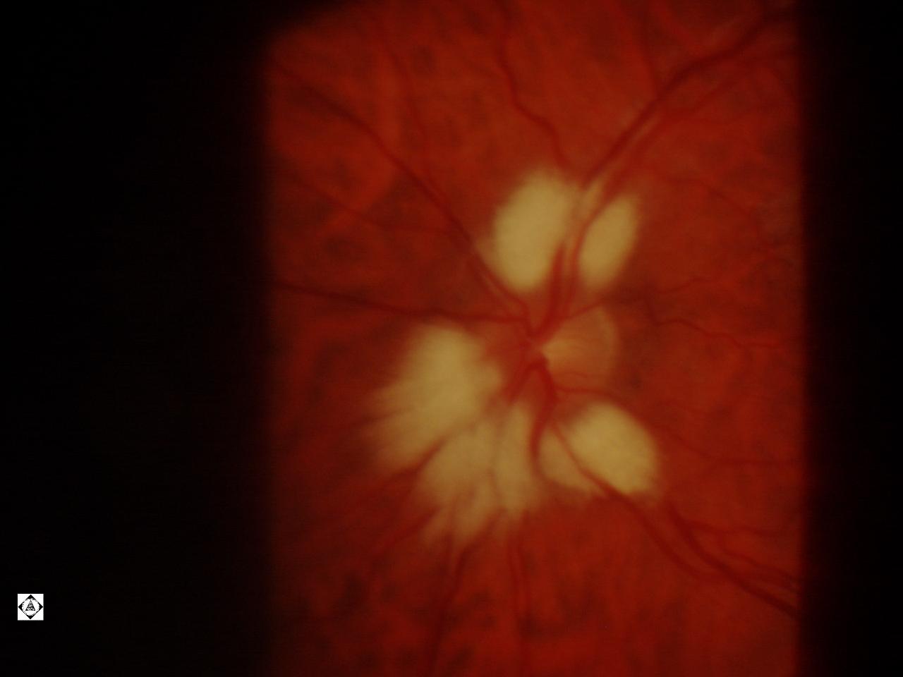 Sonoran Desert Eye Center: MYELINATED NERVE FIBERS