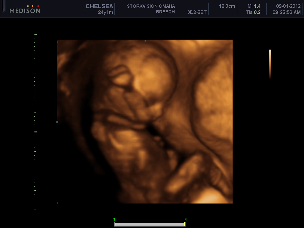 Early gender ultrasound? - BabyCenter