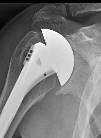 UW Shoulder and Elbow Academy: Ream and Run - x-rays at 4+ years in a ...