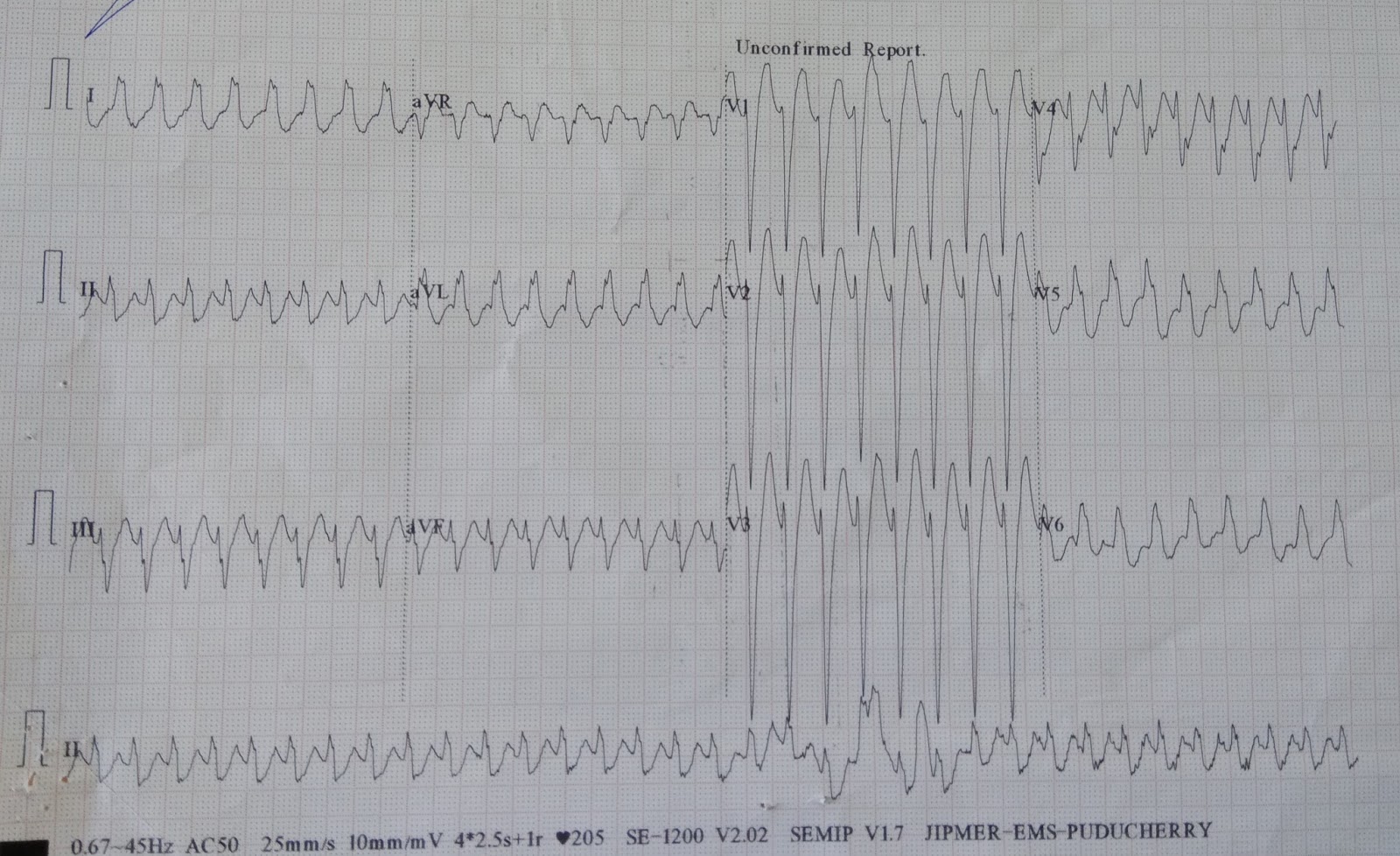 Cardiology window: SVT with aberrancy