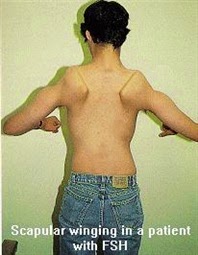 PACES WITH DR ISMAIL AYDEROOS: Fascoscapulohumeral Muscular Dystrophy