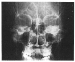 Cara (orbitas, huesos propios de la nariz (HPN), senos paranasales (SPN ...