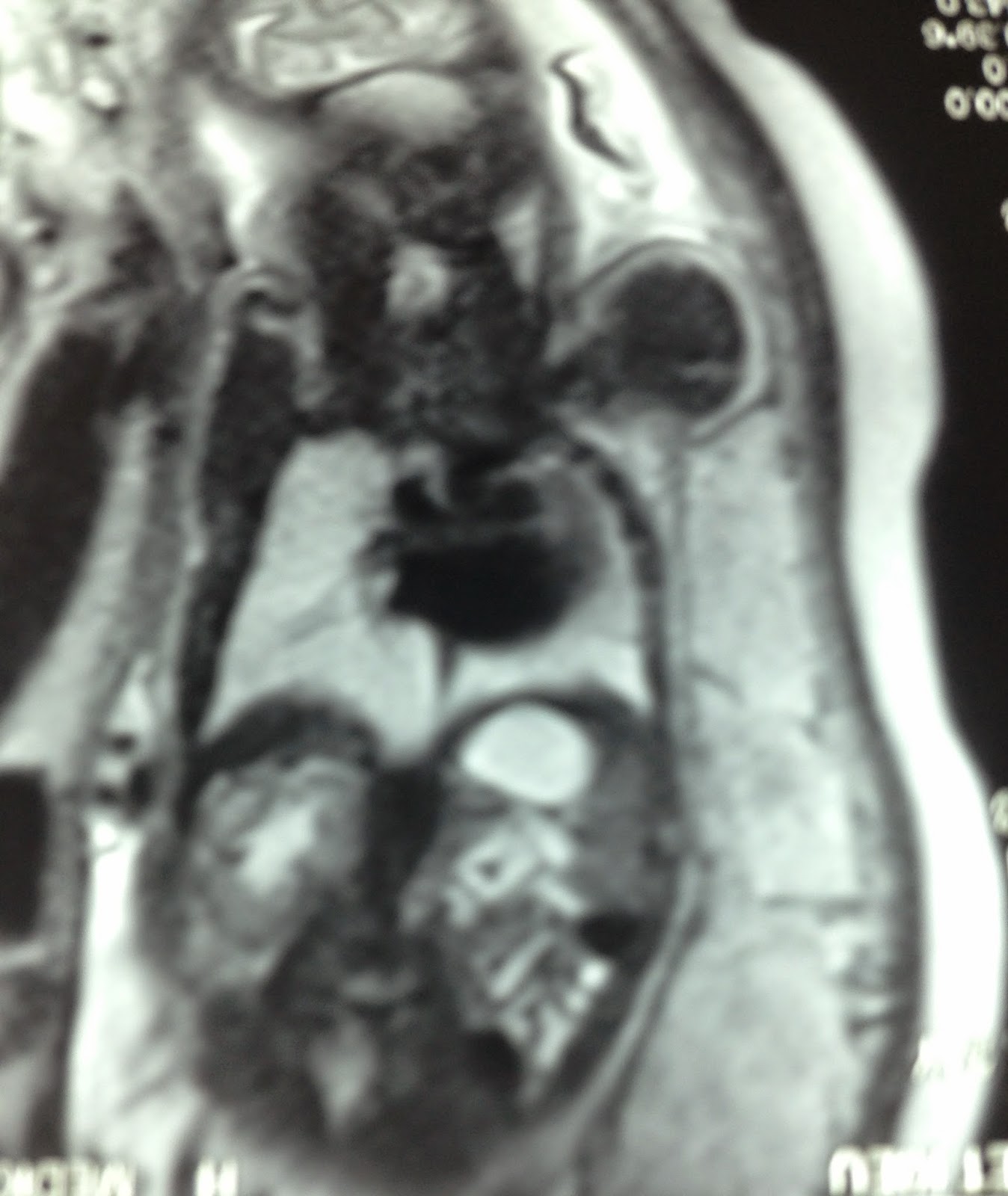 VIETNAMESE MEDIC ULTRASOUND: CASE 280: FETUS ONE KIDNEY in ...