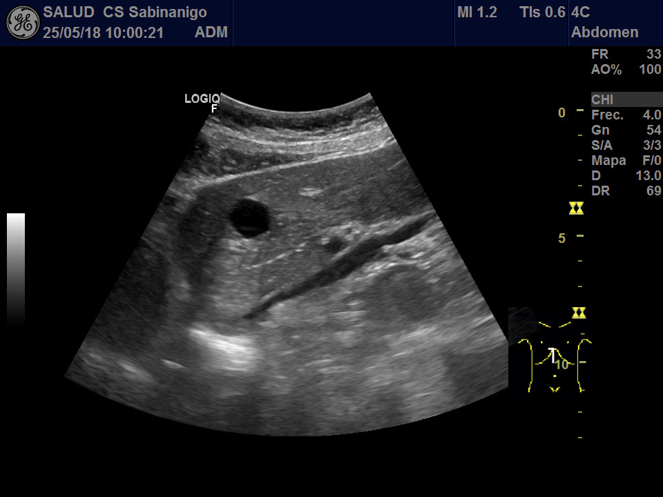 Ecografía en Atención Primaria: SEGMENTOS HEPÁTICOS