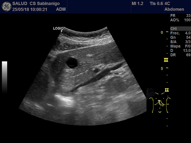 Ecografía en Atención Primaria: SEGMENTOS HEPÁTICOS