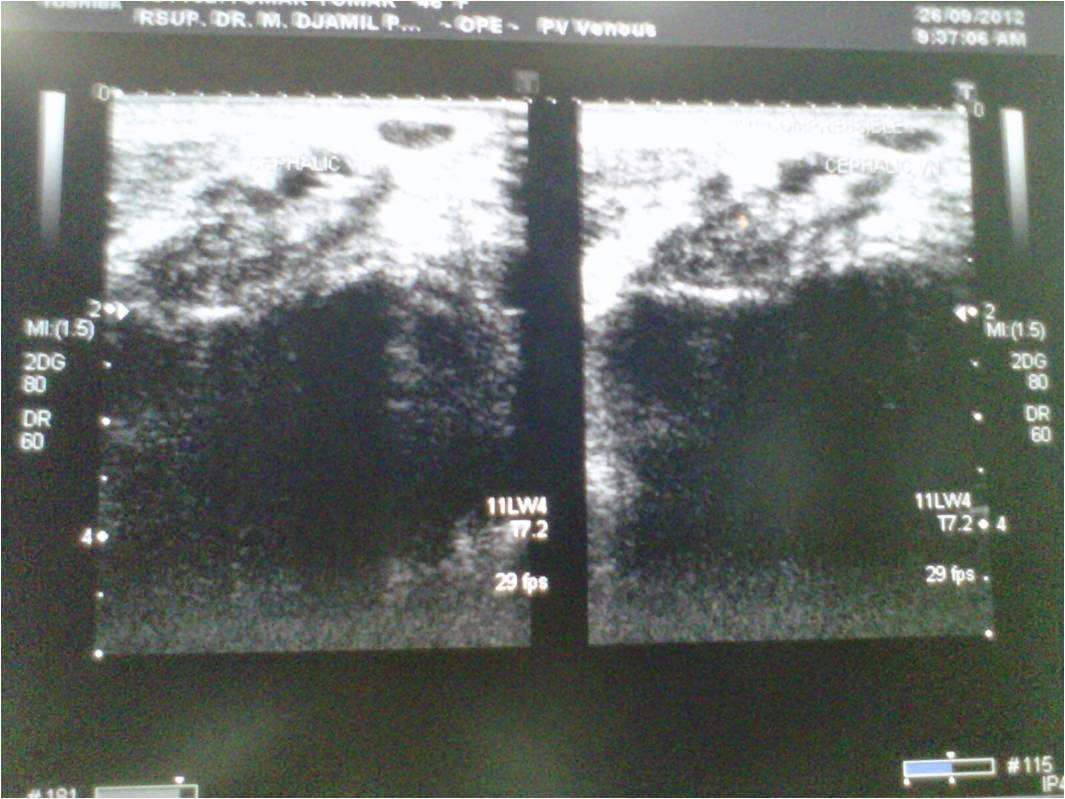 Prosedur Pemasangan Cimino-AV Fistula-AV Shunt | HEMODIALYSIS Prosedur ...