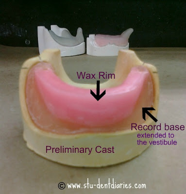Stu-DENT Diaries: Custom Tray, Record Base and Wax Rim
