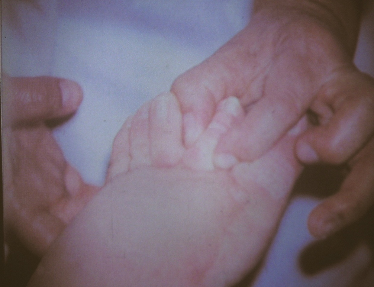 LINFEDEMA: TODO LO QUE DEBES SABER DEL LINFEDEMA