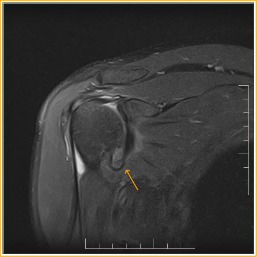 Adhesive Capsulitis: MRI - Sumer's Radiology Blog