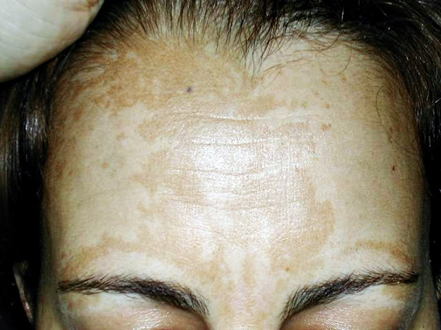 El Atelier de la Piel: Las manchas