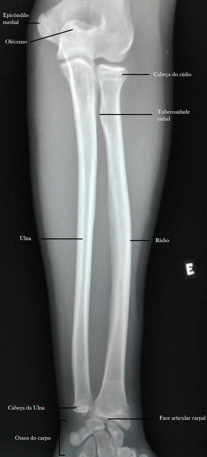 DICAS DE RADIOLOGIA: TÉCNICAS RADIOLÓGICAS - MEMBROS SUPERIORES ...