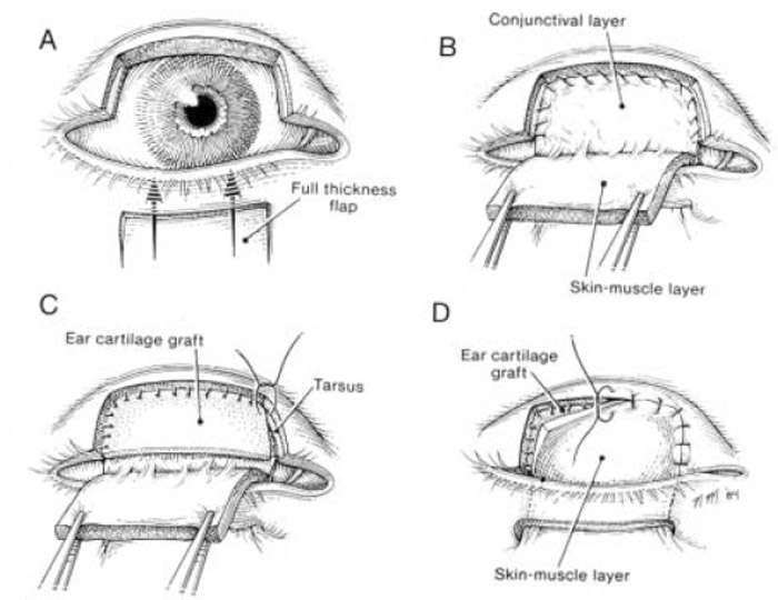 Eyelid Surgery by Prof Dr CN CHUA 蔡鐘能: Ways of Repairing Lost Upper Eyelid