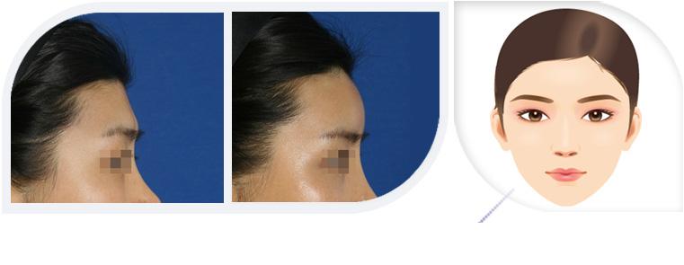 Eyelid Surgery Legend Dr. Kim Byung Gun: [Recommended Place for ...