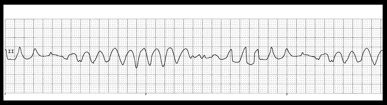 Practice EKG strips