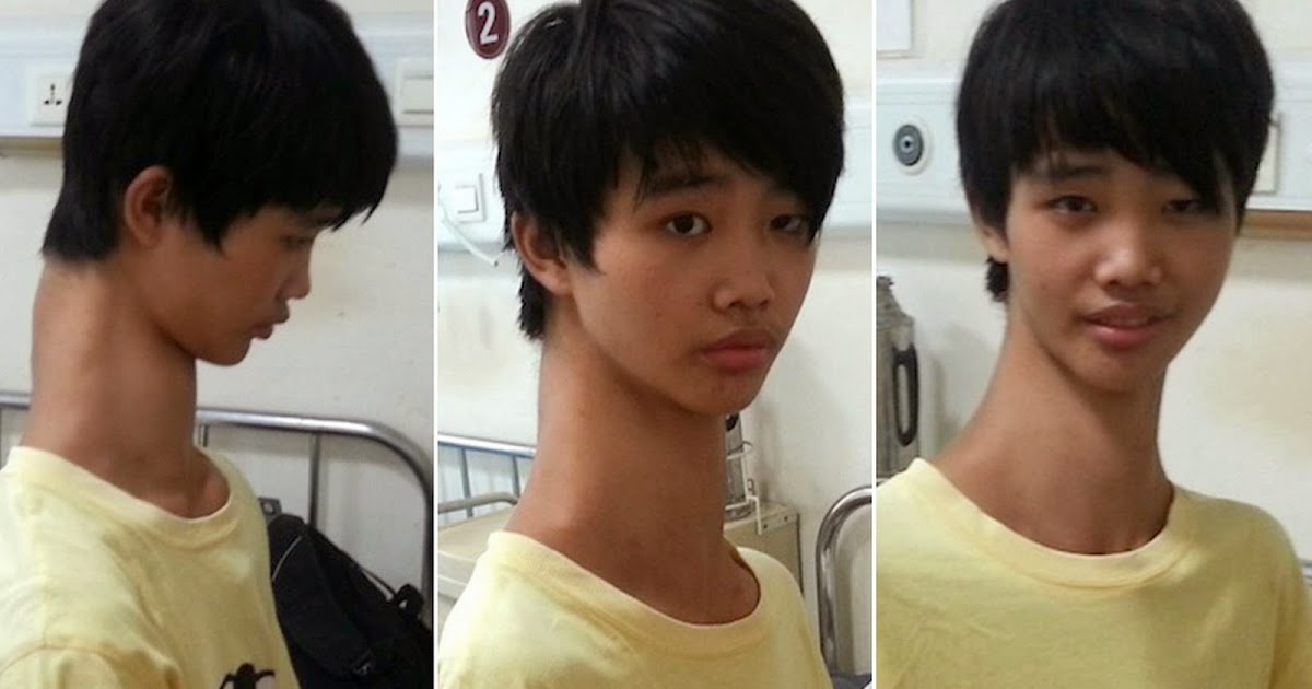 Teen With Amazingly Long Neck To Undergo Surgery : CHANKAY