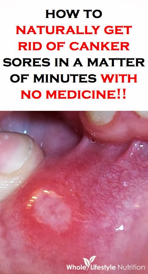 Health Miss: Causes and Home Remedies for Canker Sores