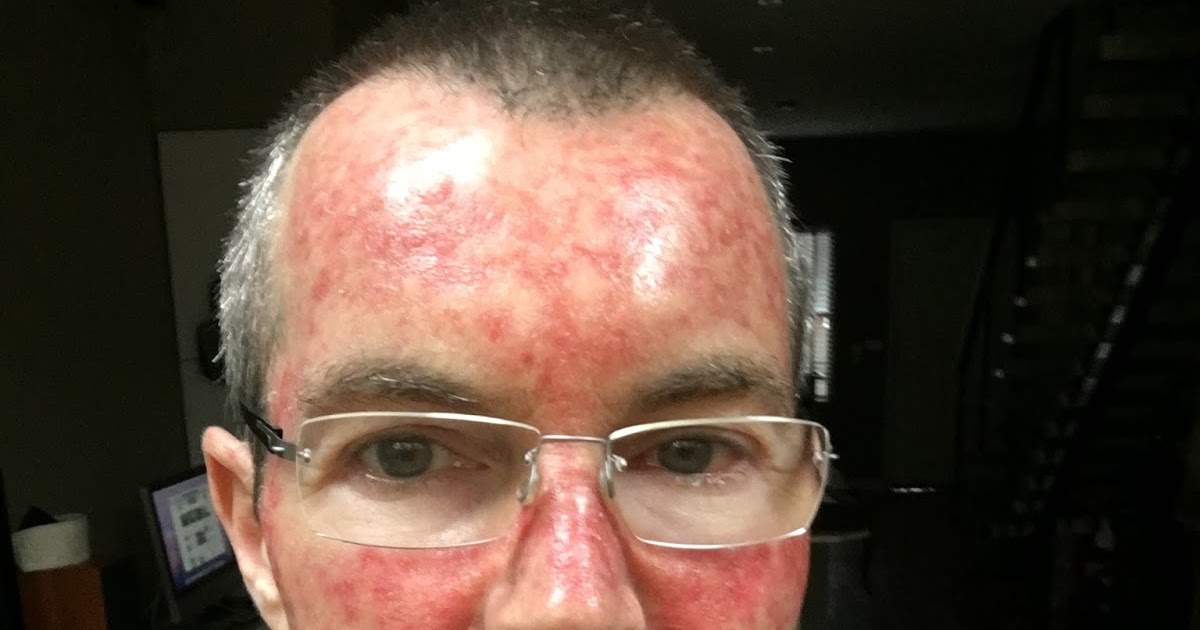 Efudix Treatment: Day 25 - Post day 6