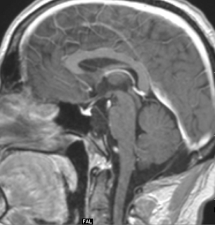 Clival Epidermoid-MRI - Sumer's Radiology Blog