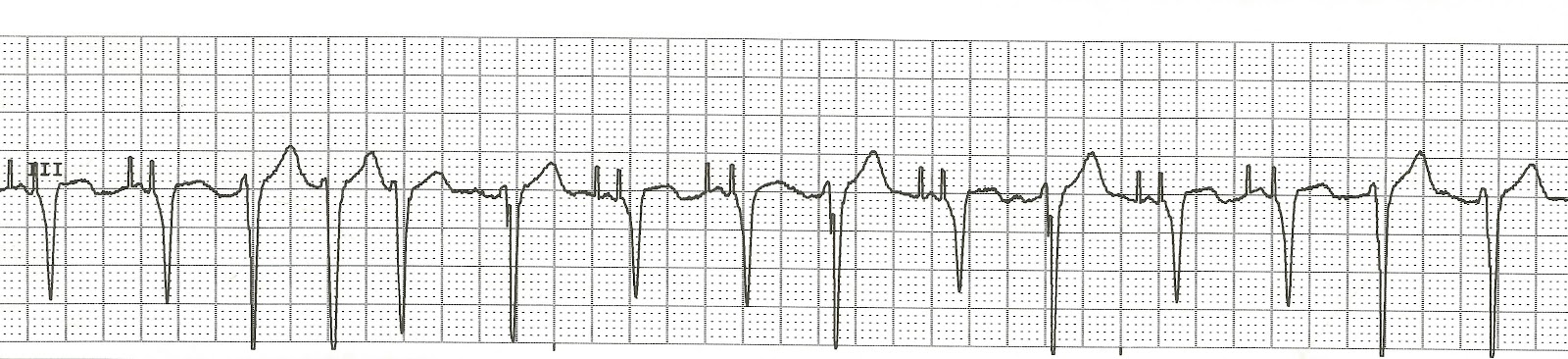 EKG Rhythm Strip Quiz 88