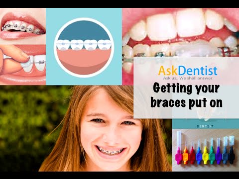 How to Take Care of Your Braces and Get 11 Braces Care Tips Now | How ...