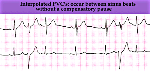 Premature Ventricular Contraction / Ventrikular Ekstrasistol | INA - ECG