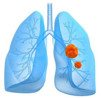 Immunotherapy for the End Stages Lung Cancer Timeline