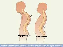 Scoliosis - Skoliosis: Lordosis and Kyphosis