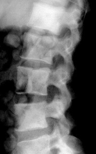 Dr Herry Setya Yudha Utama SpB. FInaCS. MHKes. ICS: Malignant Bone ...