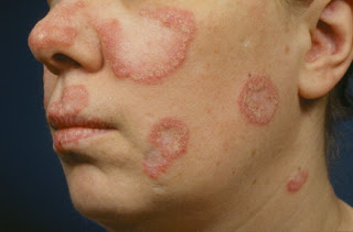 Study Medical Photos: Discoid lupus erythematosus - A Brief Discussion